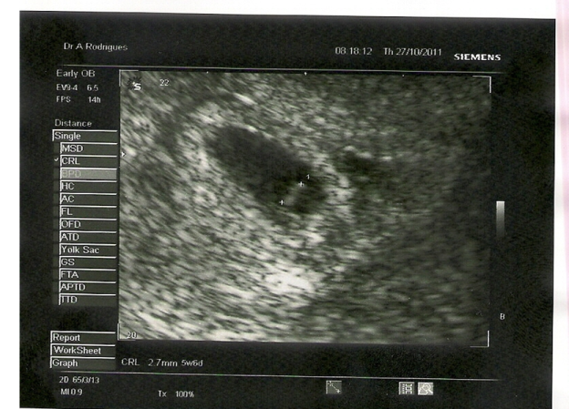 My first scan: 5w6d