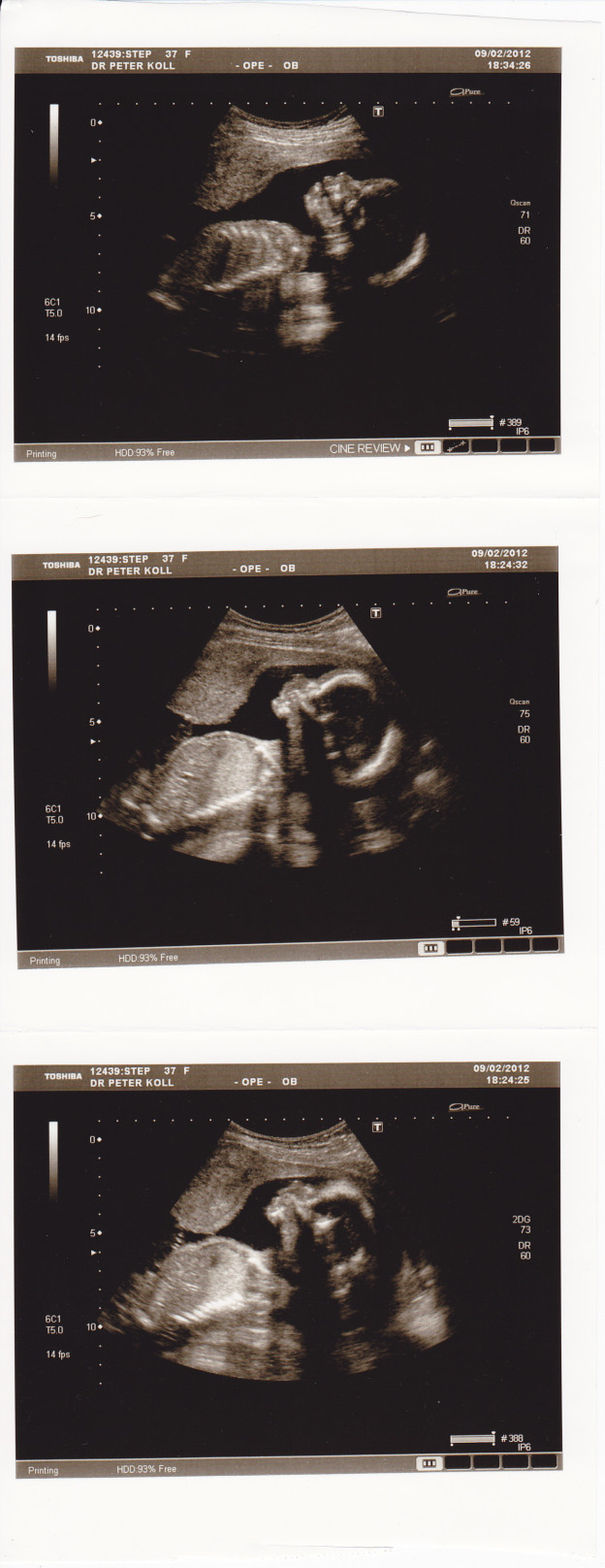 Fetal Anomaly Scan and Other News